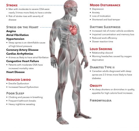 Home Sleep Apnea Testing - Sleep Medix - CPAP Clinic and Supplies